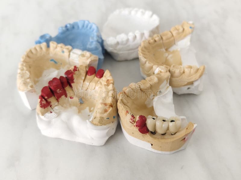 Modern Ceramic-metal Dental Bridge for Restoring Dentition Stock Image ...