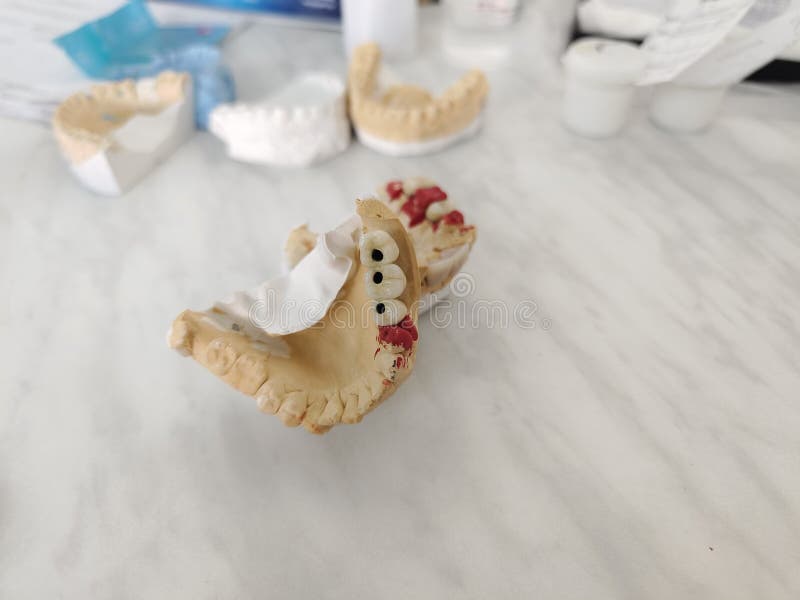 Modern Ceramic-metal Dental Bridge for Restoring Dentition Stock Photo ...