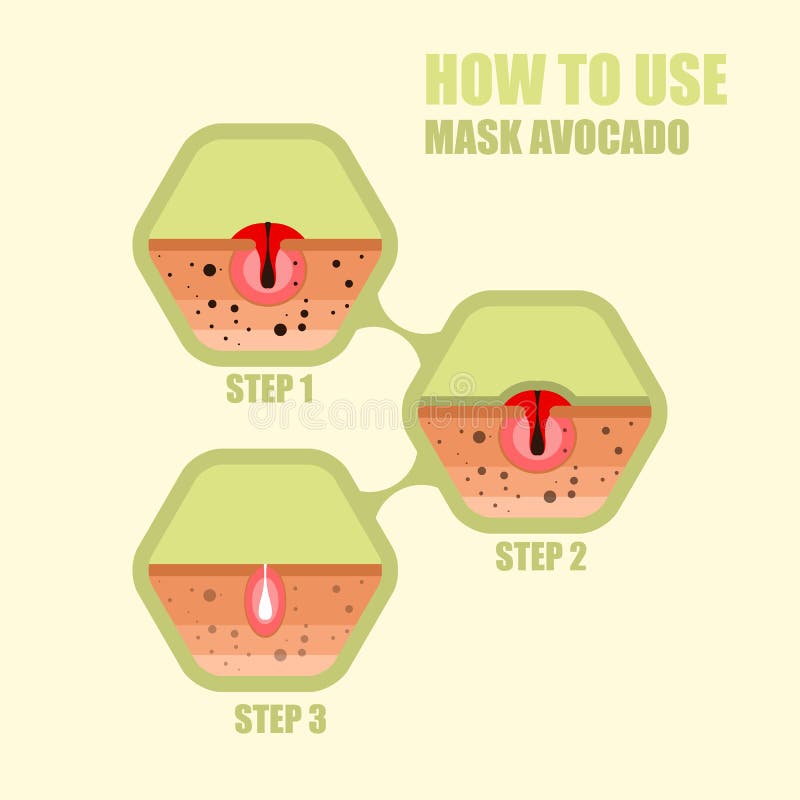 Modern Vector Illustration of Skin Problems. Dark Dots, Acne Stock ...