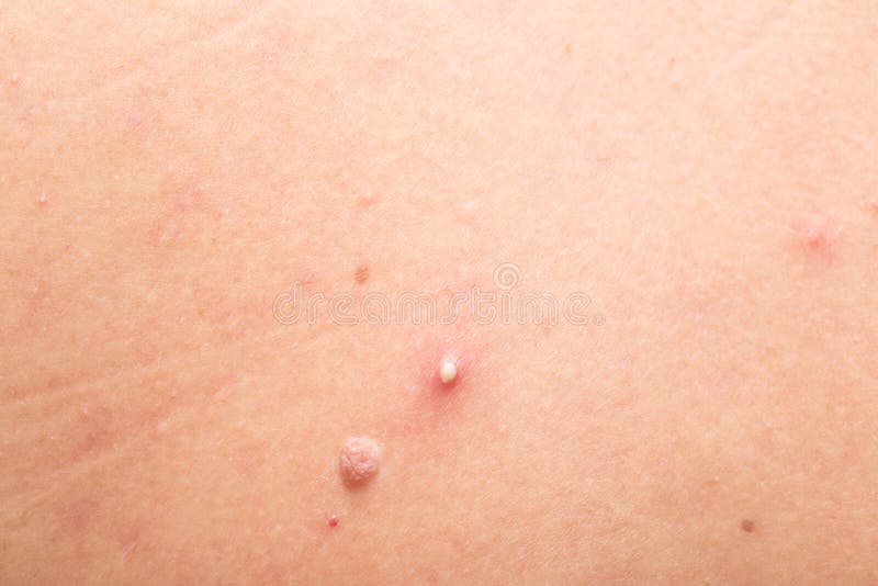 Groot Rood Pukkelabces Op De Huid, Close-up, Pukkelontsteking Op De ...