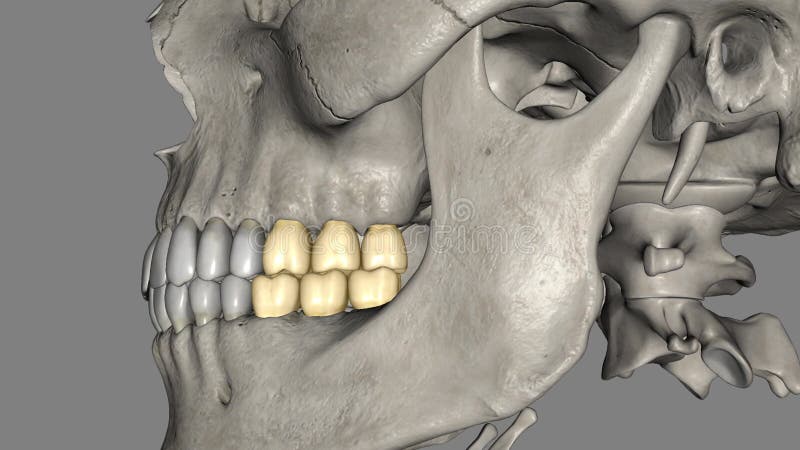 Maxillary and Mandibular Prosthesis with Gum All on 4 System Supported ...