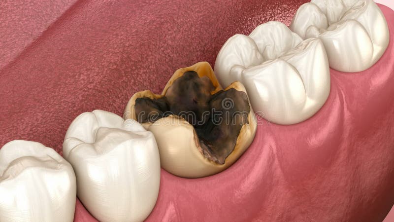 Molar Teeth Damaged by Caries. Medically Accurate Tooth Animation Stock ...