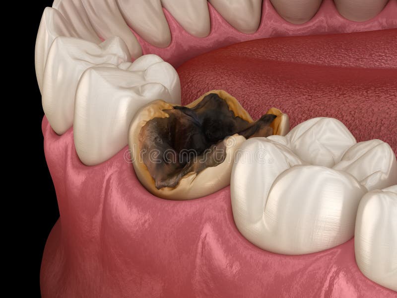 Molar Tooth Damaged by Caries. Medically Accurate Tooth 3D Illustration ...
