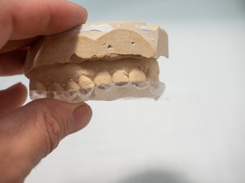 MOLD of the TEETH of a CHILD with MISPLACED TEETH an ORTHODONTIC Stock ...