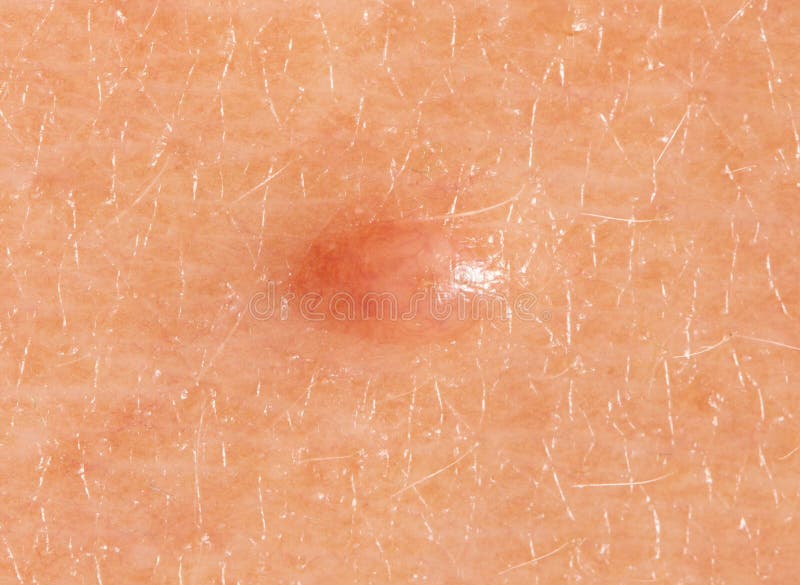Mole on human skin. Macro. stock image. Image of pigmentation - 275644539