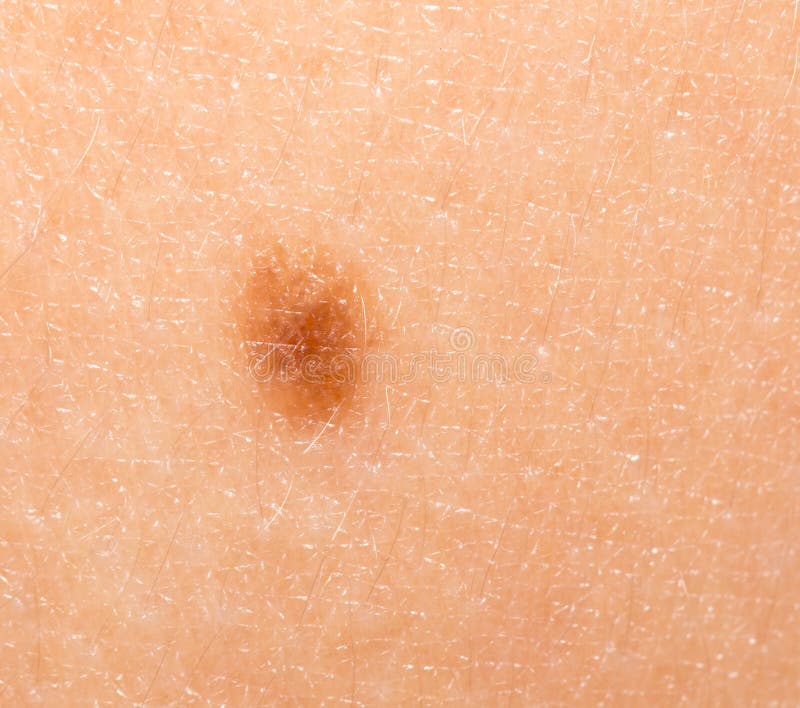 Mole on the human skin stock image. Image of people - 100383695