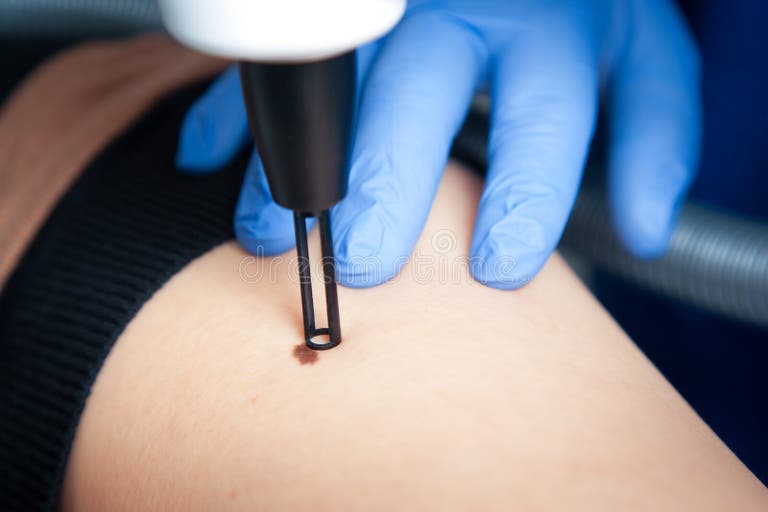 Mole medical laser stock photo. Image of medical, papilome - 39036958