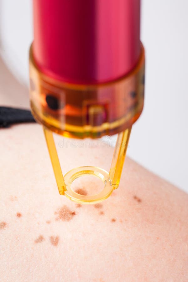 Mole medical laser stock photo. Image of health, papilome - 50931496