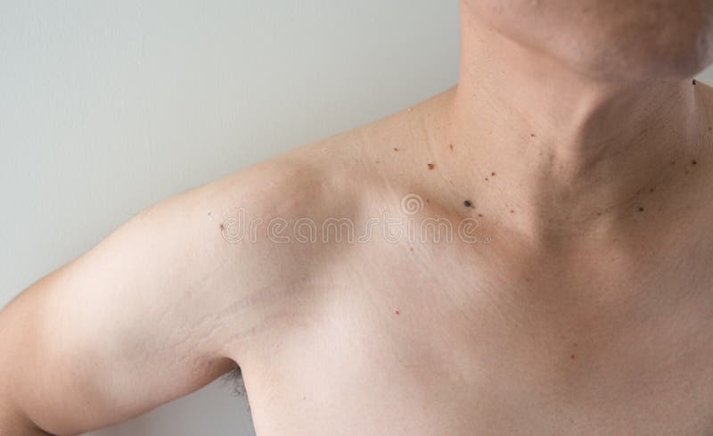 Mole on men`s skin stock image. Image of healthy, closeup - 180068021