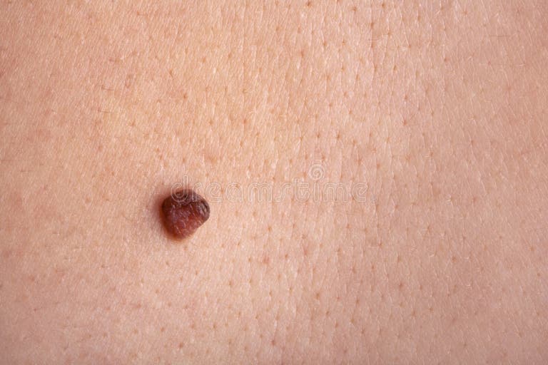 Mole on the skin stock photo. Image of brown, caucasian - 22988610