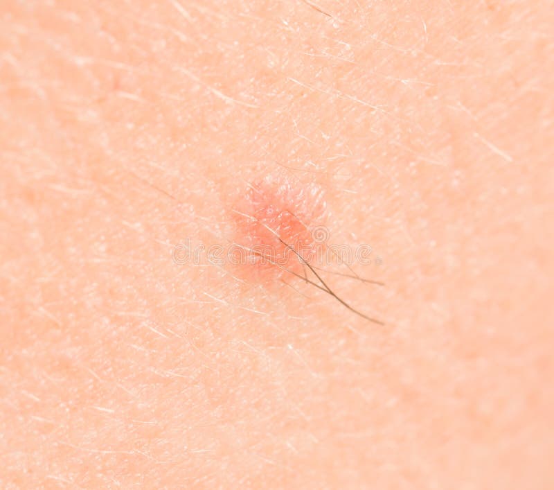 Mole on the skin stock photo. Image of brown, caucasian - 22988610