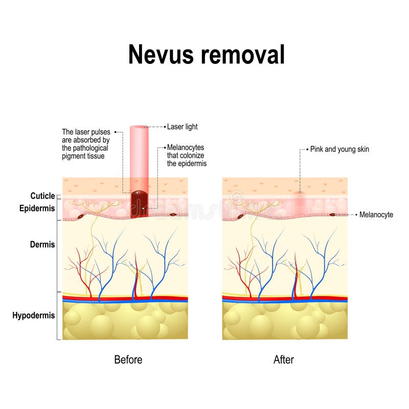 Moles Spots or Nevus Removal Stock Vector - Illustration of ...