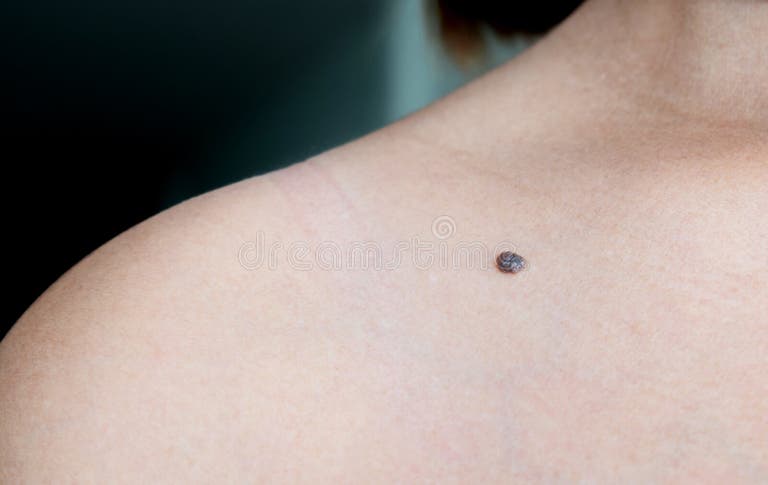 1,242 Female Moles Stock Photos - Free & Royalty-Free Stock Photos from ...