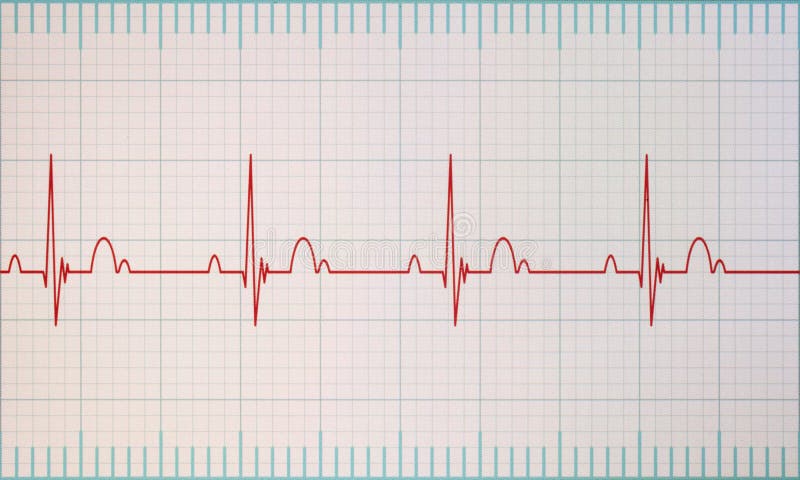 Monitor de ECG/del ECG foto de archivo. Imagen de golpeo - 54447720