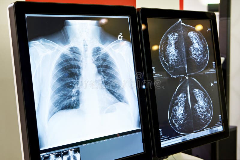 Monitors of X-ray Images of Human Stock Photo - Image of cancer, health ...