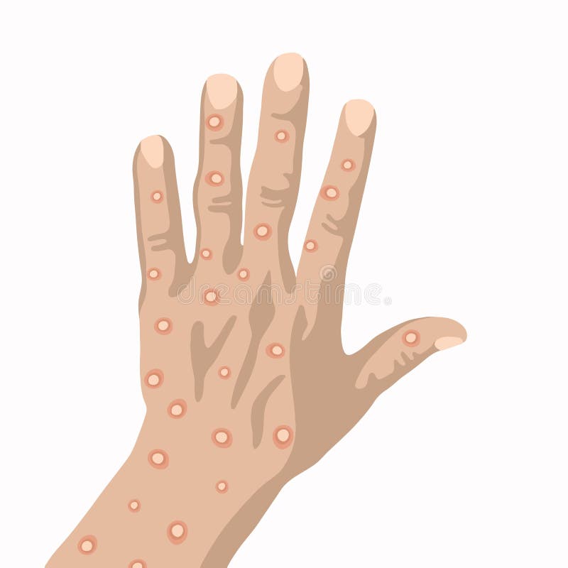 Monkey pox. stock vector. Illustration of pink, brand - 254838046