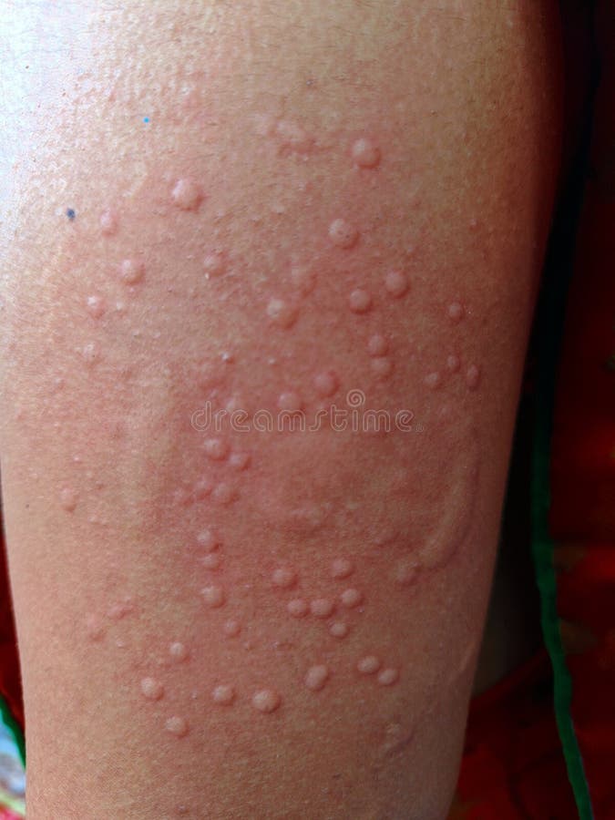 Monkey Pox Virus Transmitted in Human Body Stock Image - Image of derma ...