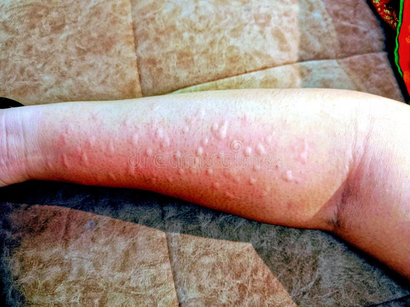 Monkey Pox Virus Transmitted in Human Body Stock Image - Image of derma ...