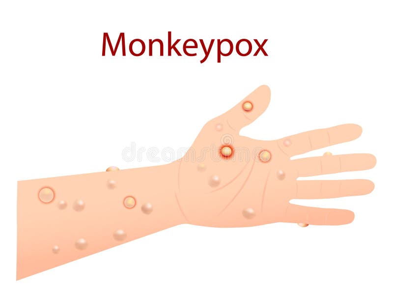 Monkeypox Virus that Can Infect Human, Stock Vector - Illustration of ...