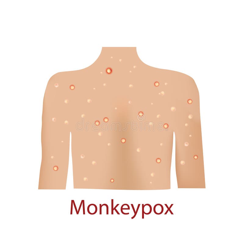 Monkeypox Virus that Can Infect Human, Monkey Pox. Vector Stock Vector ...