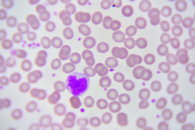 Monocyte cell stock photo. Image of leukemia, analyzing - 92593956