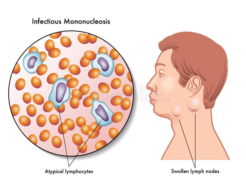 Sintomas Da Doença Da Mononucleose Infecciosa Ilustração do Vetor ...