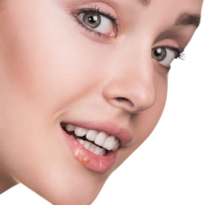Herpes Virus Op Menselijke Lippen Vrouw Met Herpes Zore Op Lippenmond ...