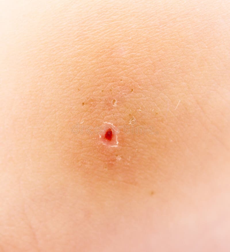Morso di insetto immagine stock. Immagine di sfondo, veleno - 43833455