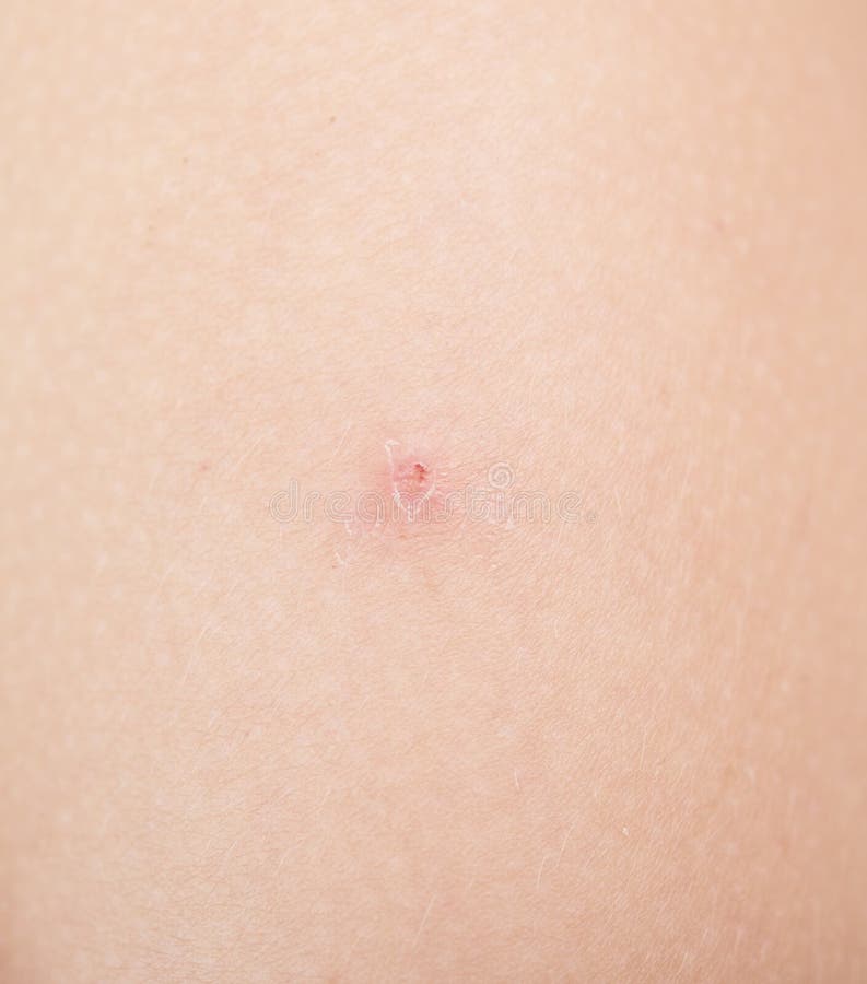 Morso di insetto fotografia stock. Immagine di reazione - 50930514