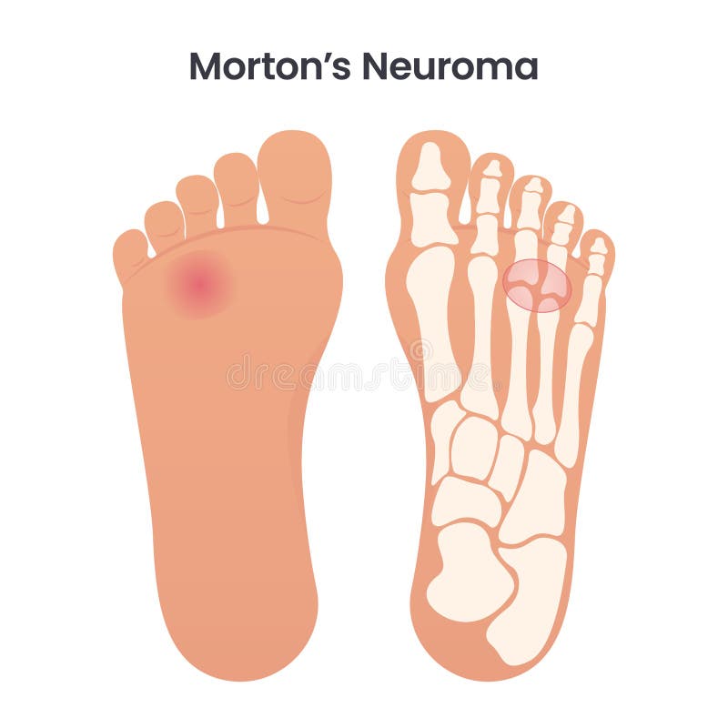 Mortons Neuroma Stock Illustrations – 8 Mortons Neuroma Stock ...