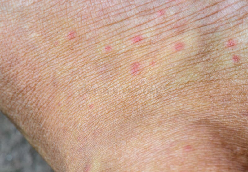 Bed bug bites on a foot stock photo. Image of insect - 27214516