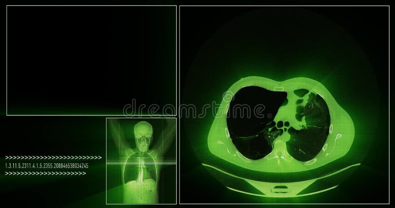 A Motion Ct Scan Of Emphysema In The Right Lung 4k Animation Stock Video Video Of Blue