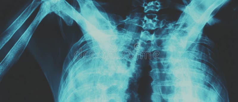 X-ray Texture Revealing Mottled and Uneven Organic Patterns in Human ...