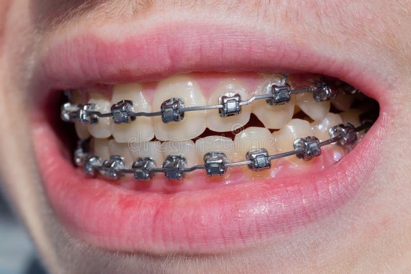 Teen with Red Metal Braces Orthodontics Brackets Stock Photo - Image of ...