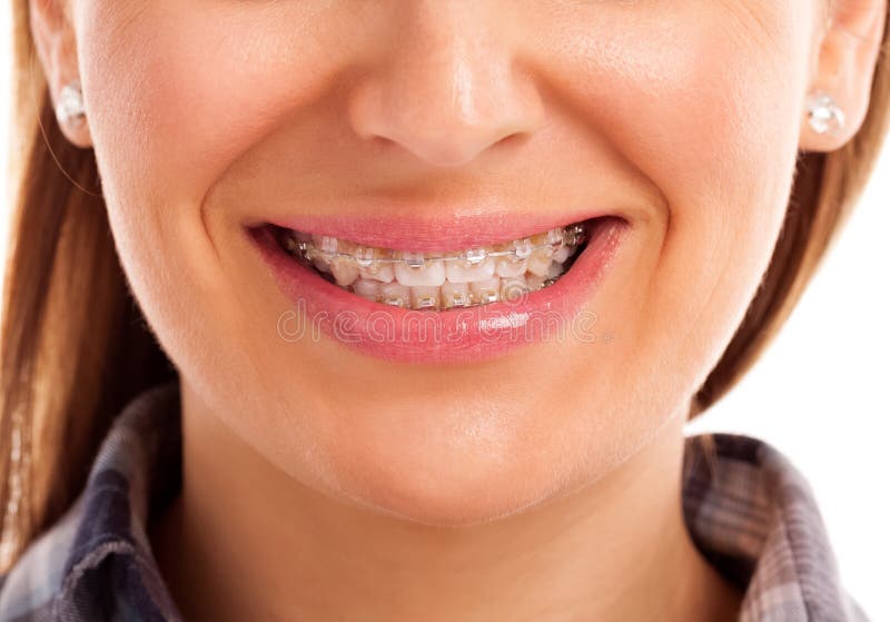 Mouth Care Teeth with Braces Stock Image - Image of orthodontics ...