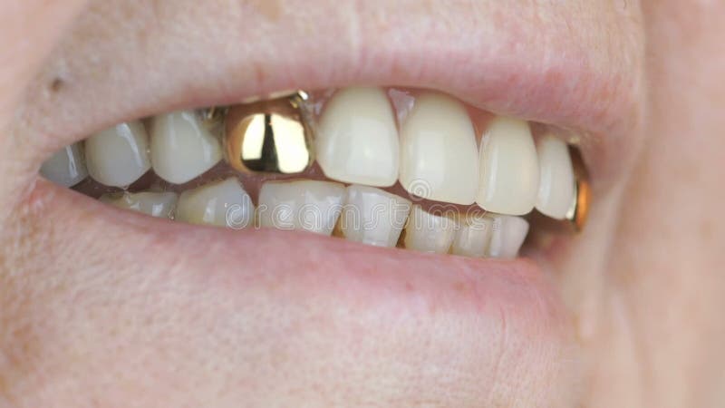 The Mouth of an Elderly Man with False Teeth. an Older Man Pulls His ...