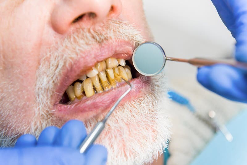 Bad teeth, closeup stock image. Image of clinical, clinic - 13048313