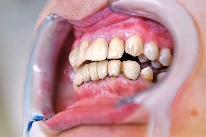 Mouth with Prosthetic Teeth Stock Photo - Image of gingivitis, close ...
