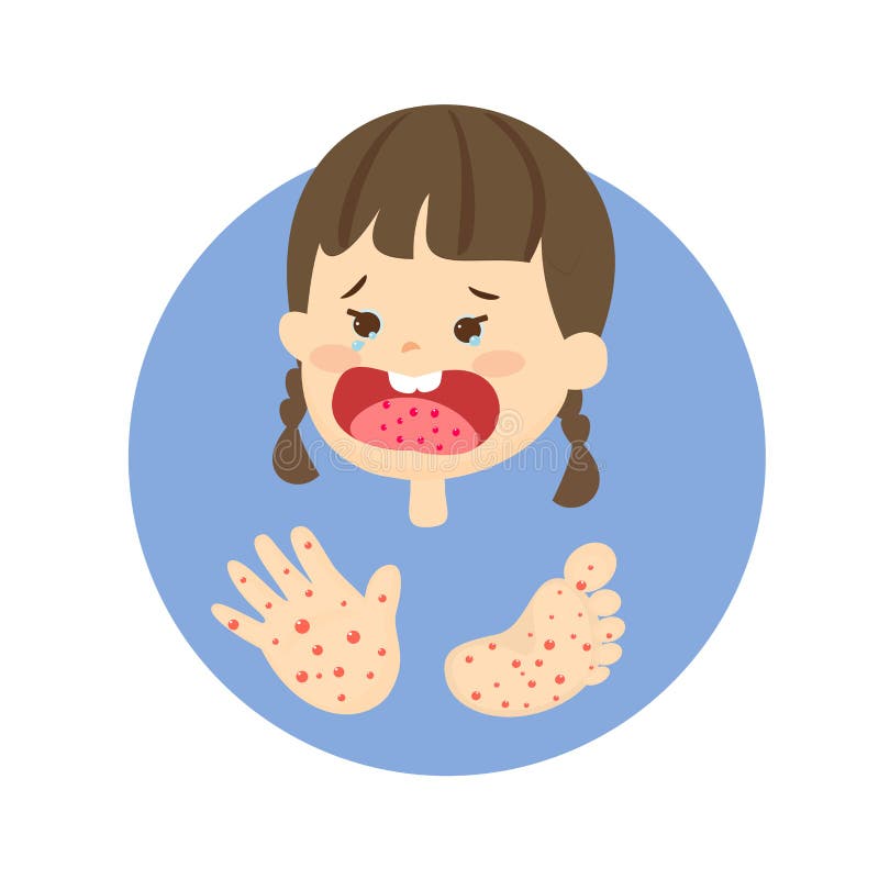 Hand Foot Mouth Disease Stock Illustrations – 130 Hand Foot Mouth ...