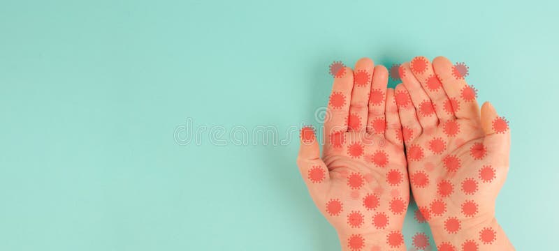 Mpox, Hands with Monkeypox Rash, Outbreak of the MPXV Virus, Infectious ...