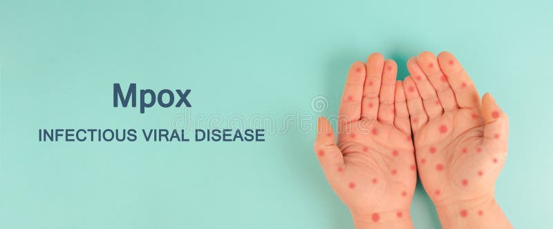 Mpox, Hands with Monkeypox Rash, Outbreak of the MPXV Virus, Infectious ...