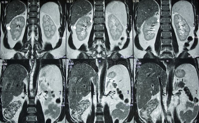 MRI of Abdomen stock photo. Image of operating, health - 9305914