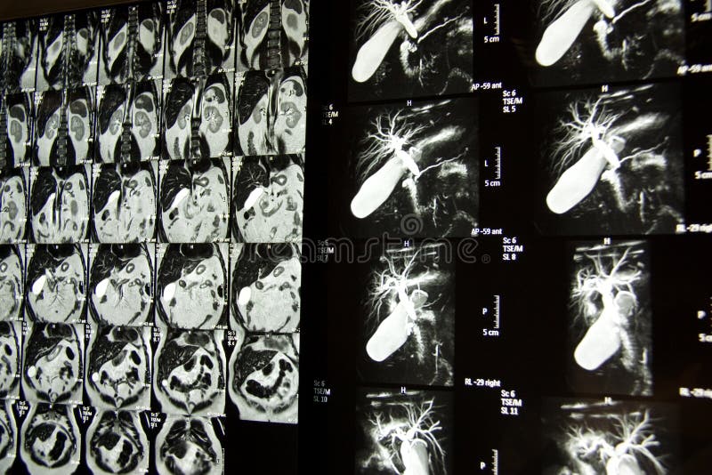 Hand Vessels, Angiography, Arteriography Stock Image - Image of artery ...