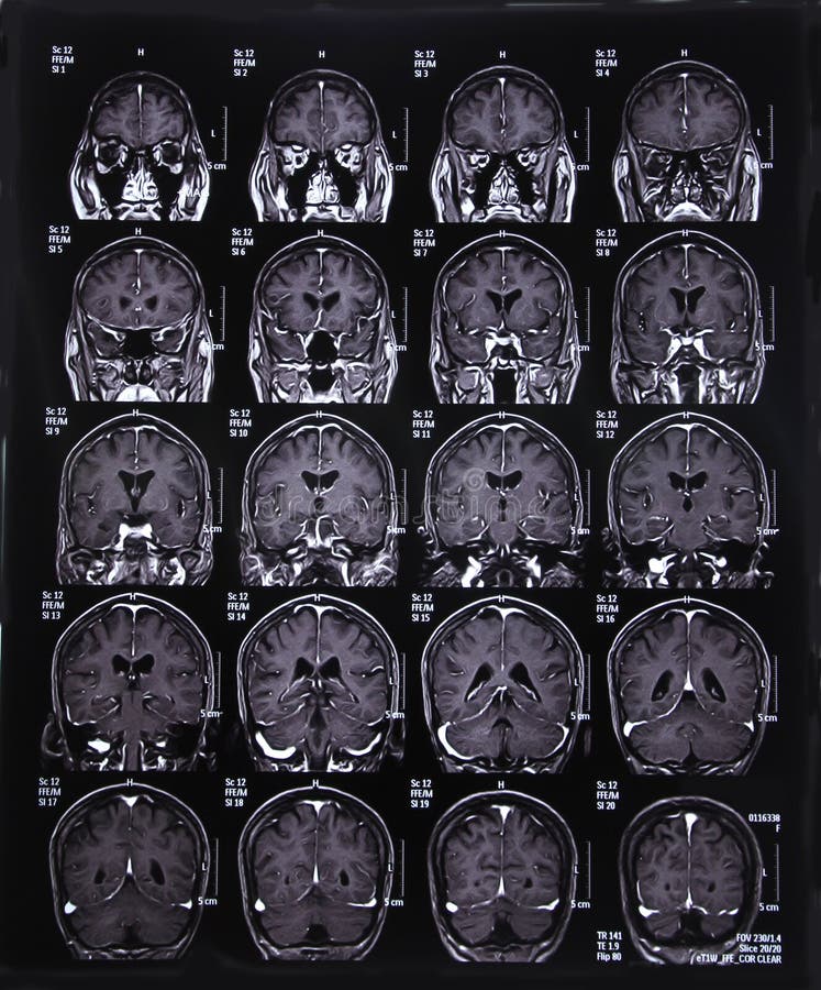 MRI-aftastenbeeld Van Hersenen Stock Foto - Image of diagnose ...