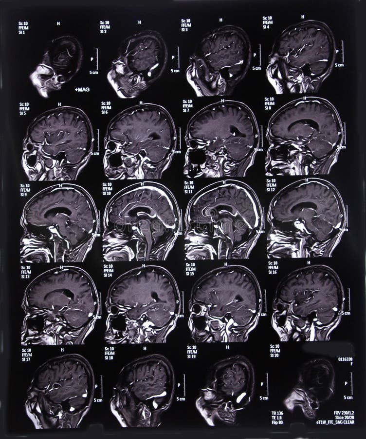MRI-scan van de hersenen stock afbeelding. Image of hersenen - 34023841