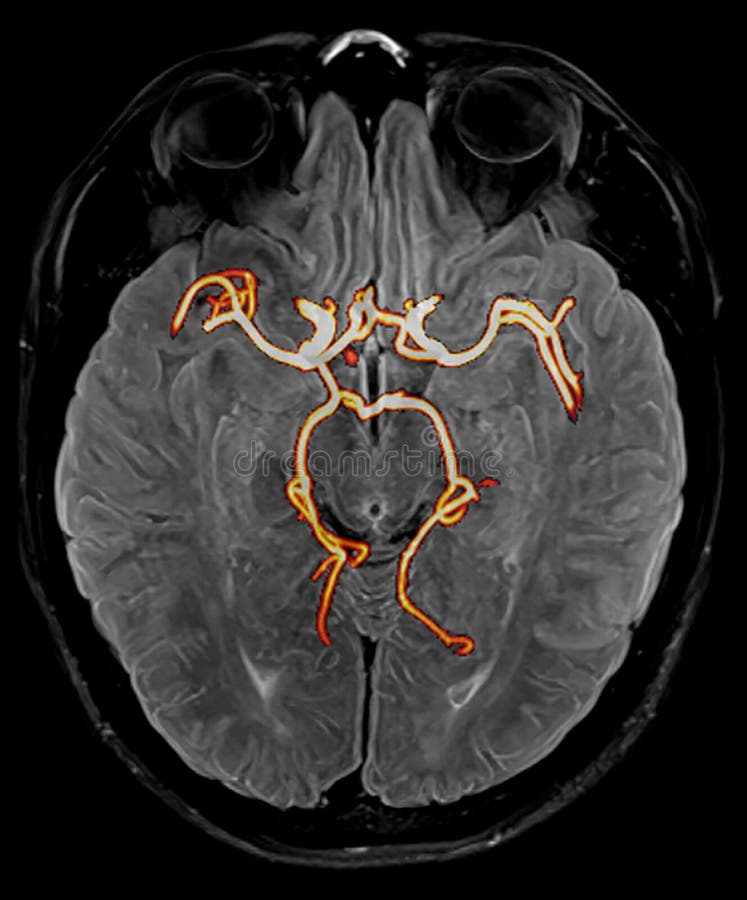 MRI Fusion of Willis Polygon Stock Illustration - Illustration of ...