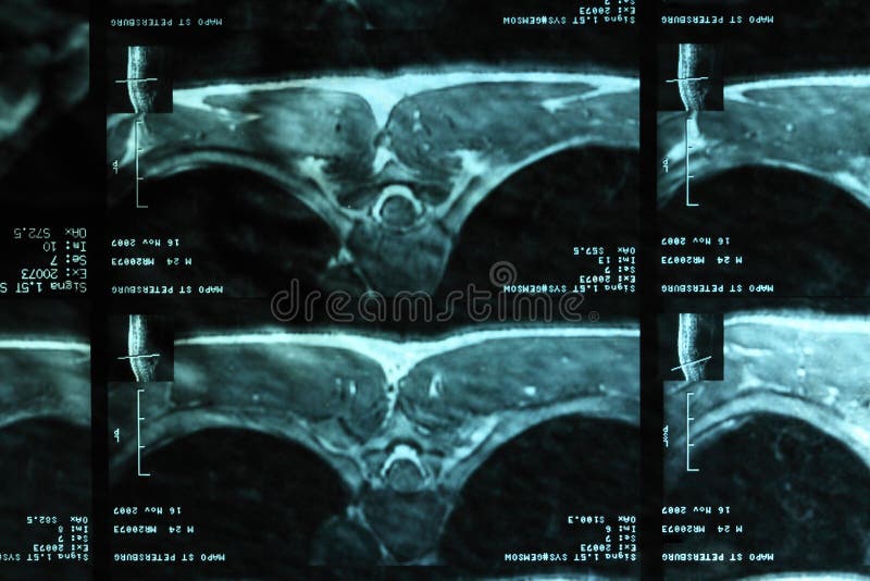 Mri of a backbone stock image. Image of backbone, roentgen - 8940803