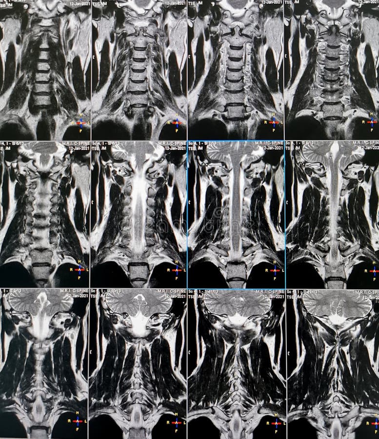 Mri-beelden Mri Cervicale Wervelkolom T2weight Coroneel Plan Stock Foto ...