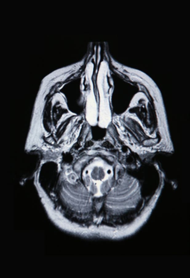 MRI of the Brain stock image. Image of head, neurosurgery - 1520947