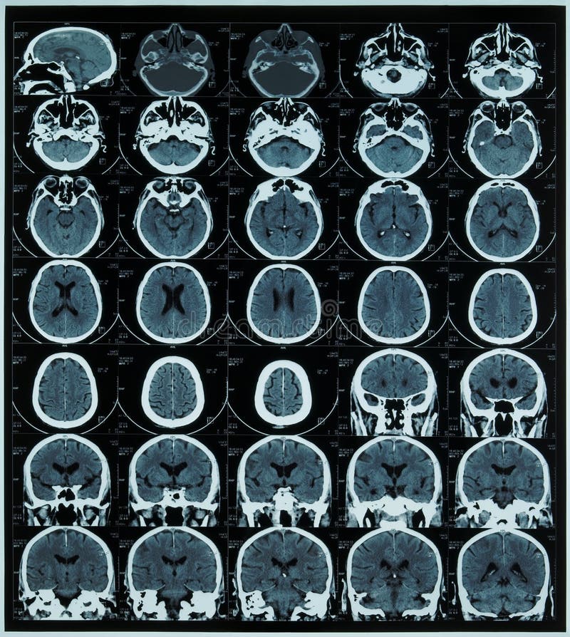 MRI Brain Scan stock photo. Image of hypothalamus, human - 4245594
